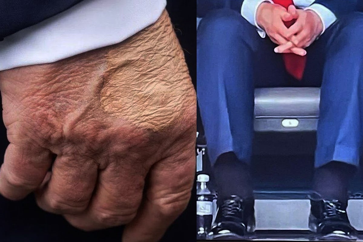 Donald Trump padece insuficiencia venosa crónica ¿Qué es esto?